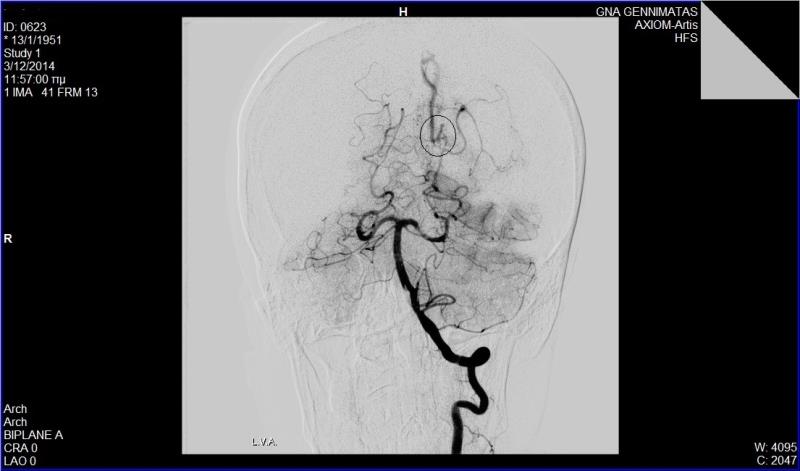 Αρτηριοφλεβώδης Δυσπλασία (AVM) - Νευροχειρουργική Κλινική Γ.Ν.Α. Γ ...
