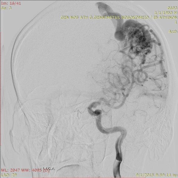 Resection of left paramedian parietooccipital AVM - Νευροχειρουργική ...