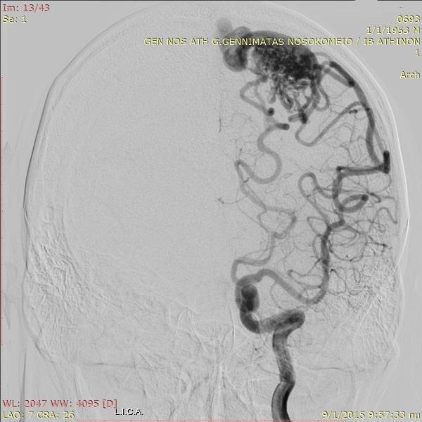 Resection of left paramedian parietooccipital AVM - Νευροχειρουργική ...