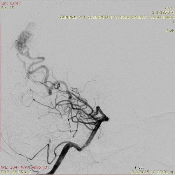 Resection of left paramedian parietooccipital AVM - Νευροχειρουργική ...