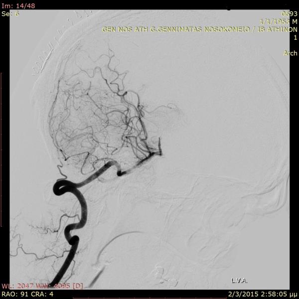 Resection of left paramedian parietooccipital AVM - Νευροχειρουργική ...
